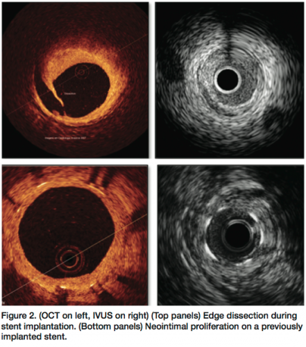 Optical Coherence Tomography Vs Ivus